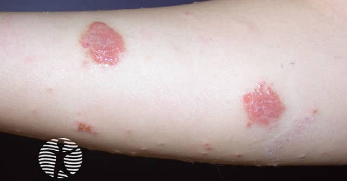 Nummular dermatitis discoid eczema image