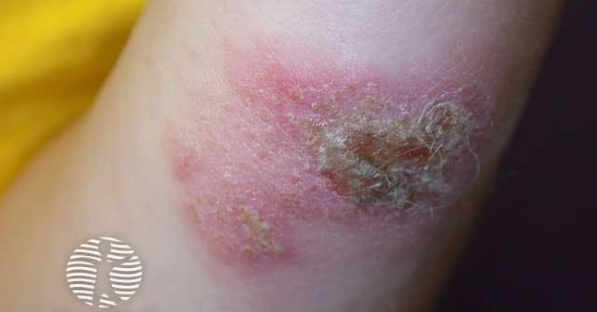 Nummular dermatitis discoid eczema image