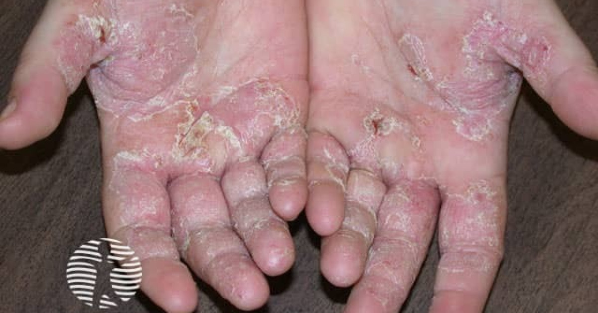 Palmar dermatitis image