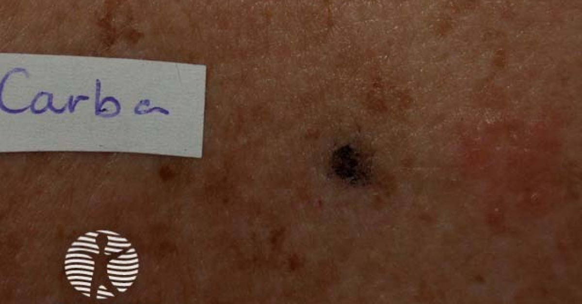 Patch test image