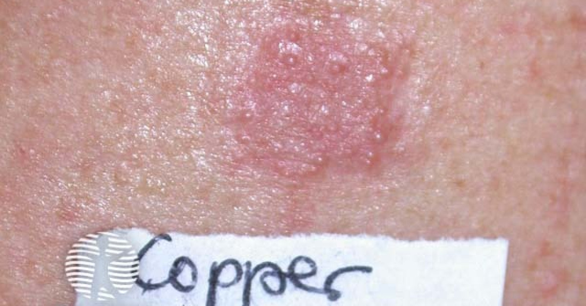 Patch test image