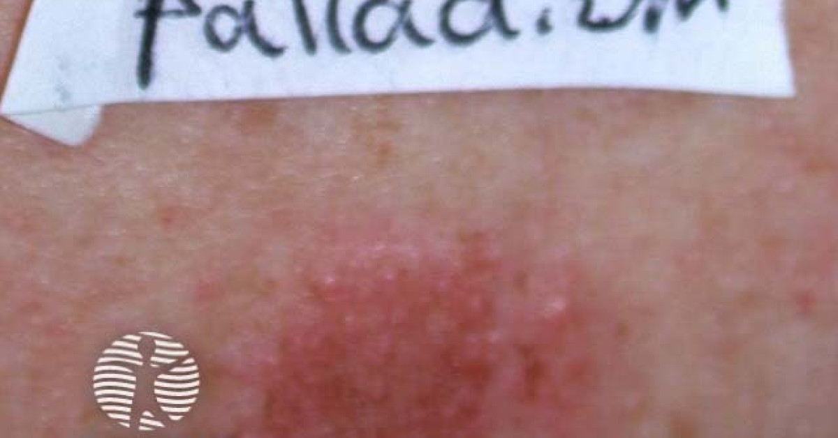 Patch test image