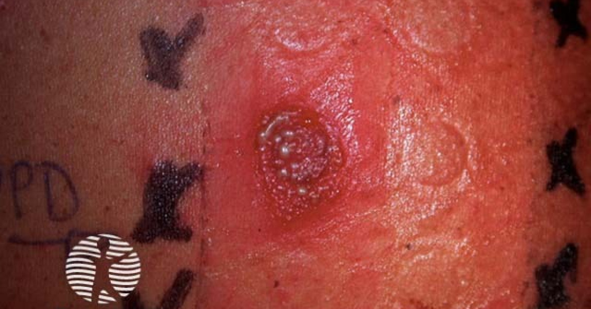 Patch Test Image