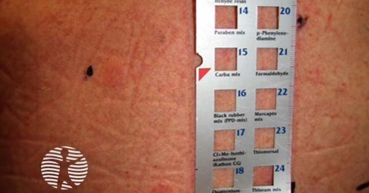 Patch test image