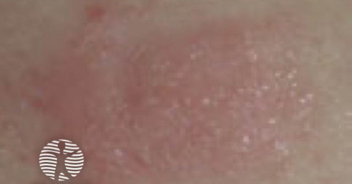 Positive patch test to formaldehyde image