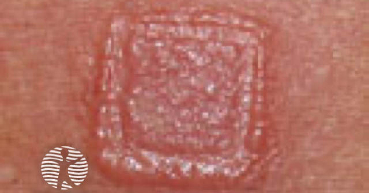Positive patch test to rosin image
