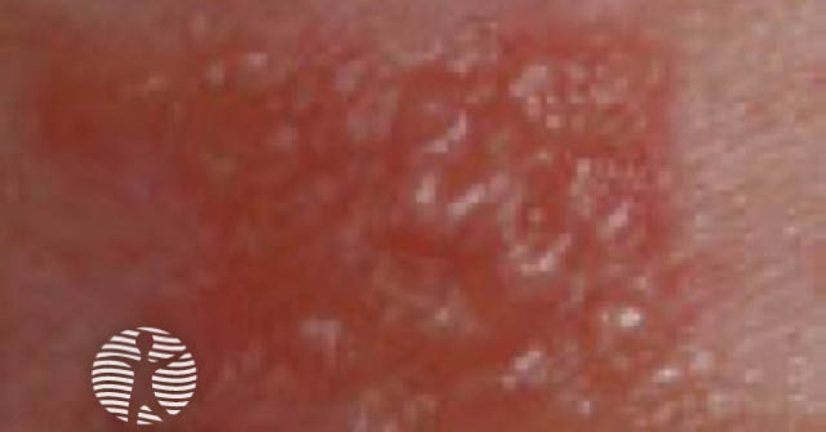 Positive patch test to balsam of Peru image