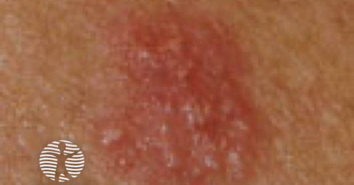 Positive patch test to tixocortal image