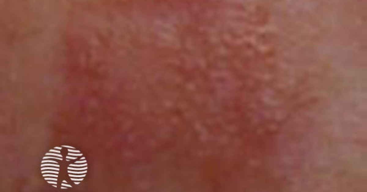 Positive patch test to potassium dichromate image