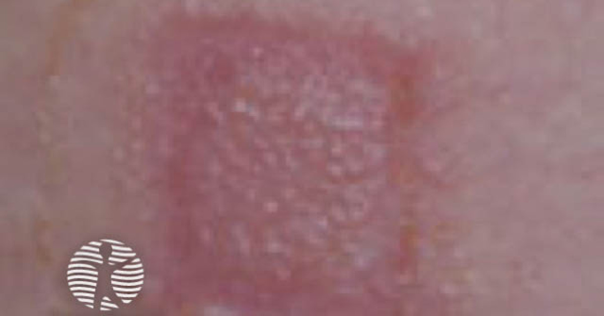 Positive patch test to epoxy resin image