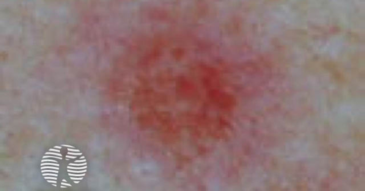 Positive patch test to thiomersal image