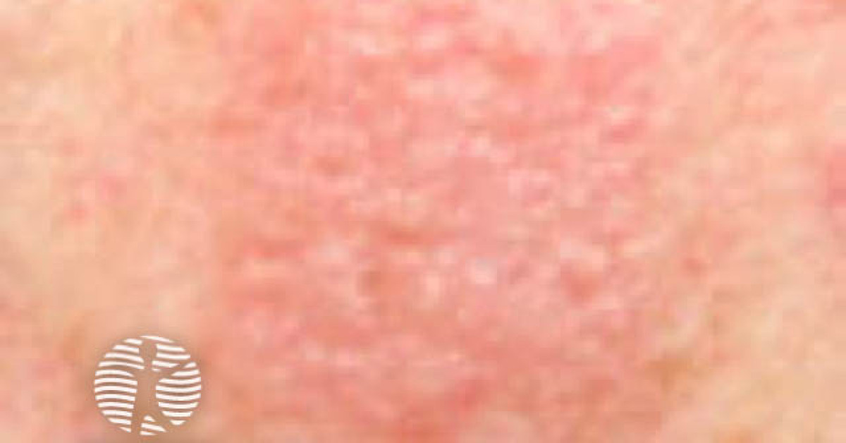 Positive patch test to carba mix image