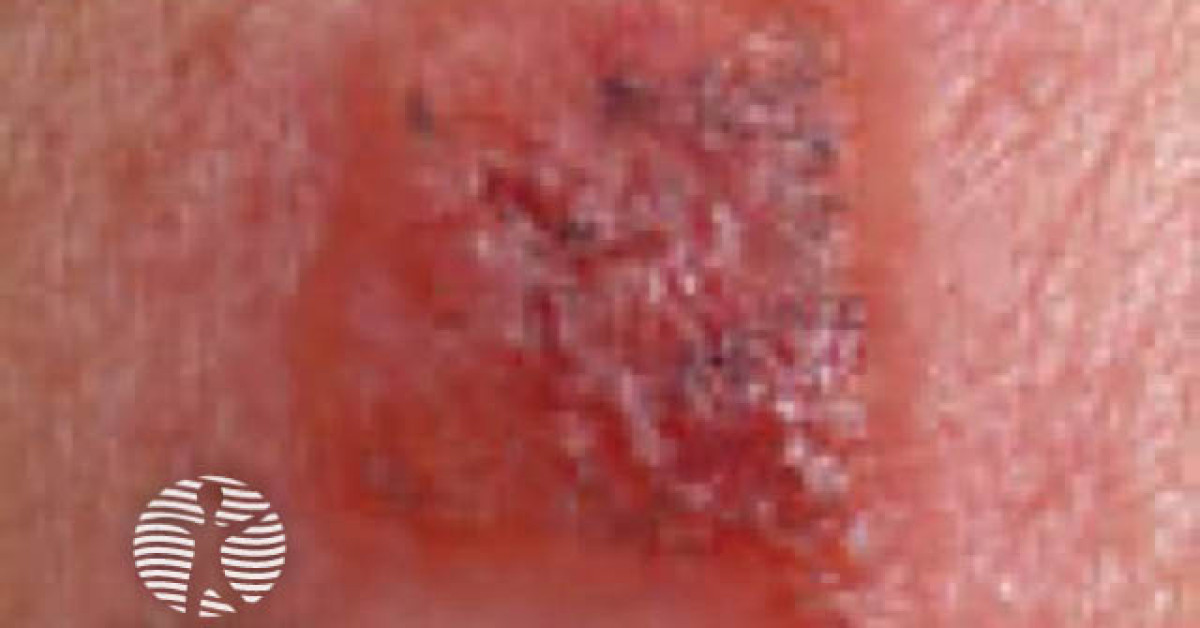 Positive patch test image