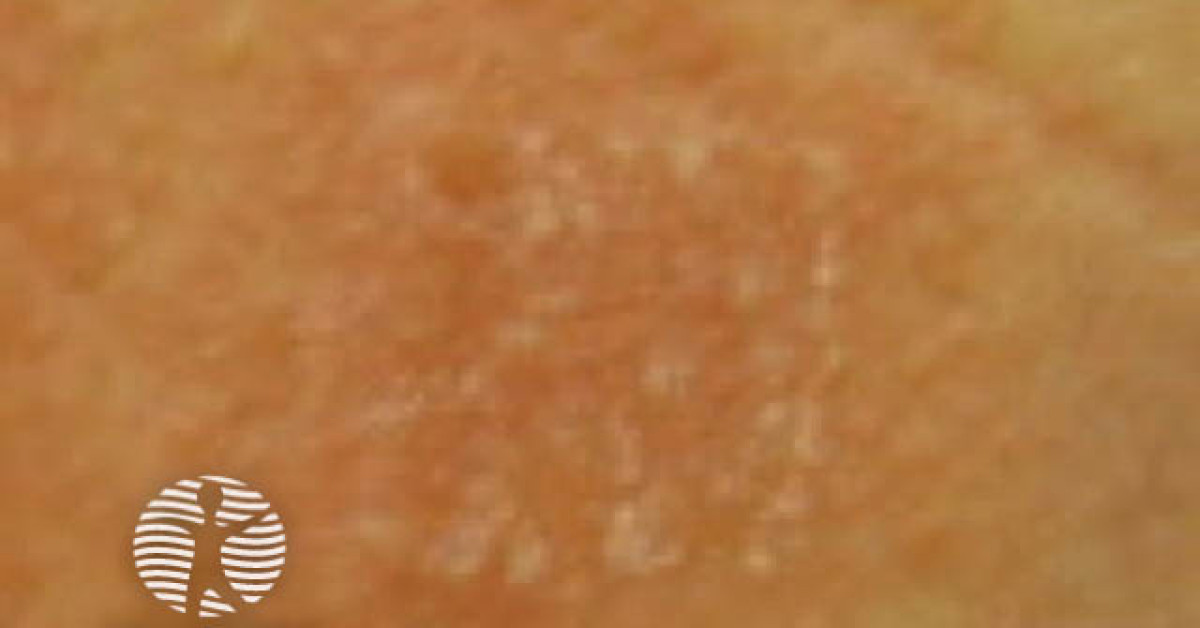 Positive patch test to imidazolidinyl urea image