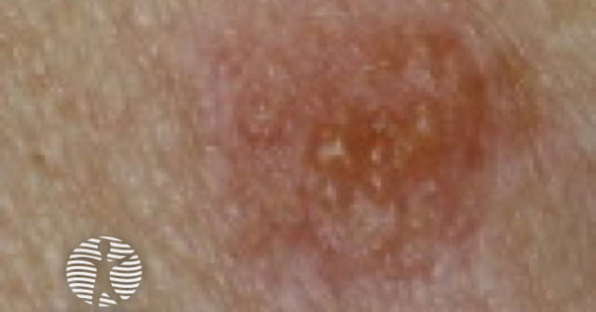 Positive patch test to bronopol image