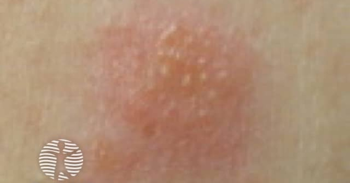 Positive patch test to sodium thiosulfate (gold) image