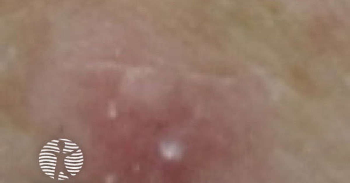 Positive patch test to melamine formaldehyde image