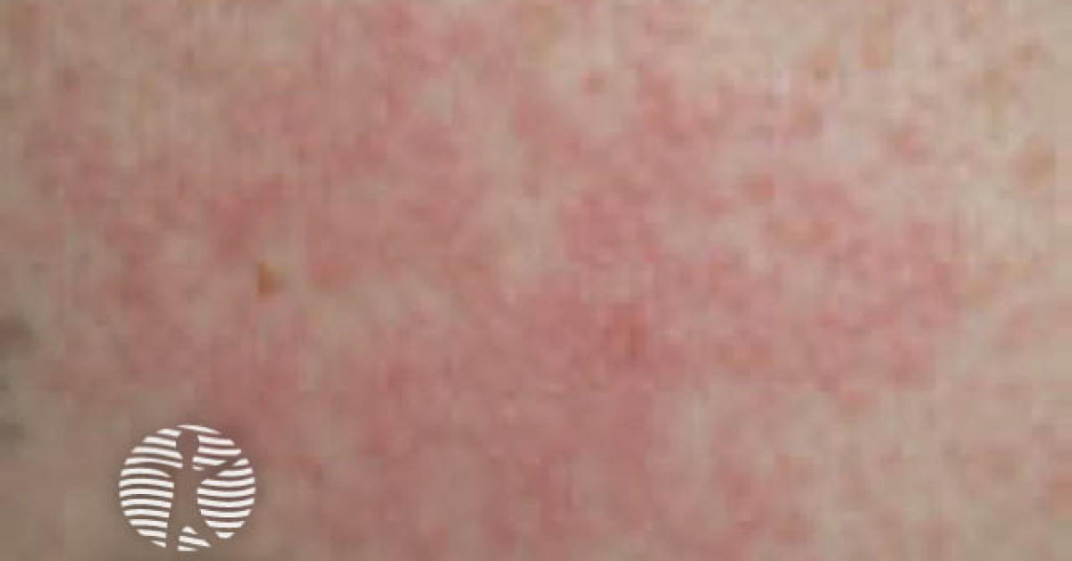 Positive patch test to neomycin image