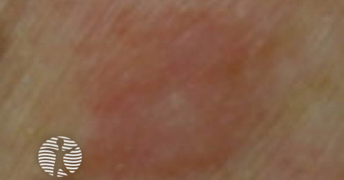 Positive patch test to glyceryl monothioglycolate image