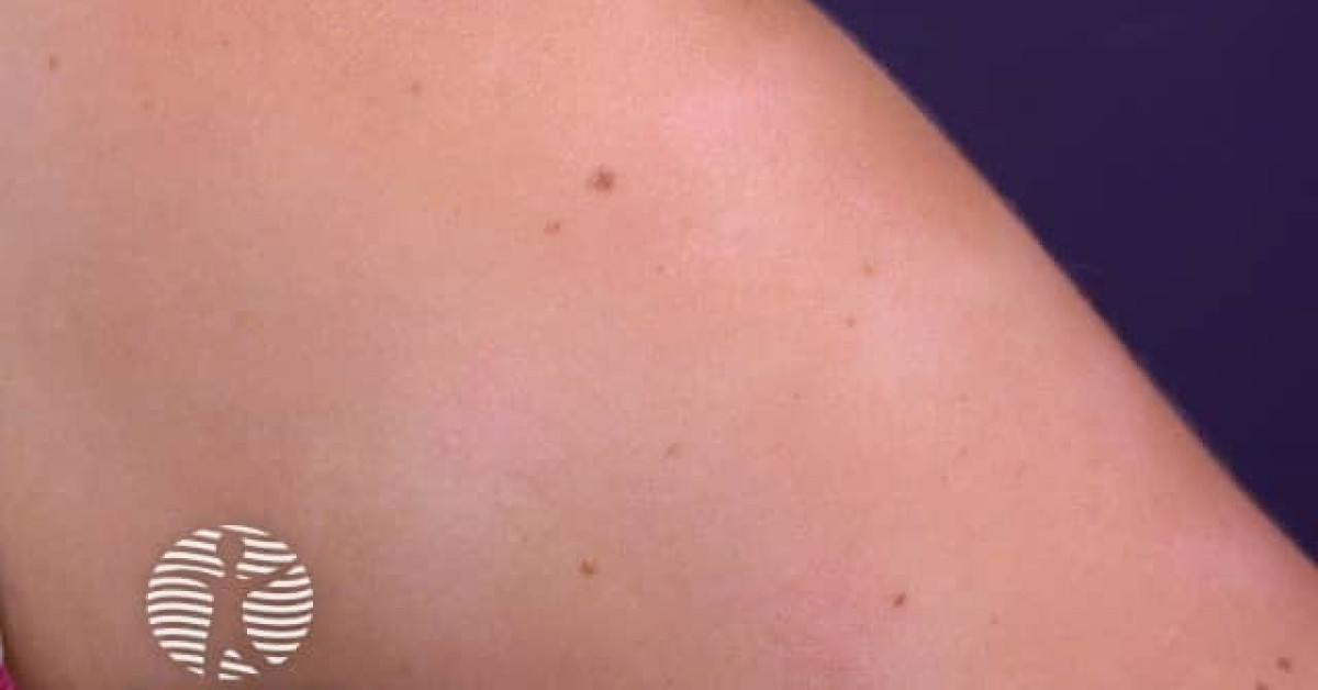 Pityriasis alba image