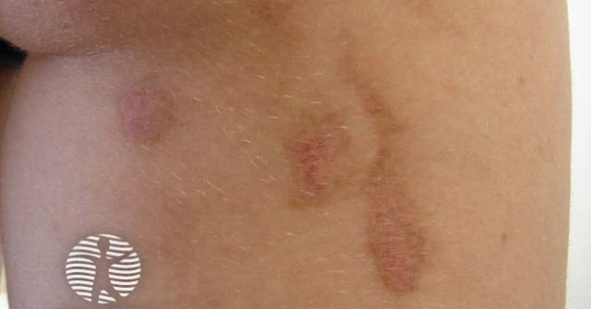 Photocontact dermatitis image