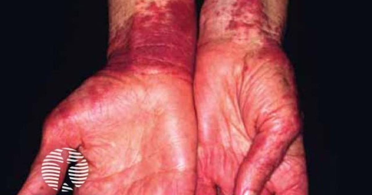 DermNet® - Primula obconica image