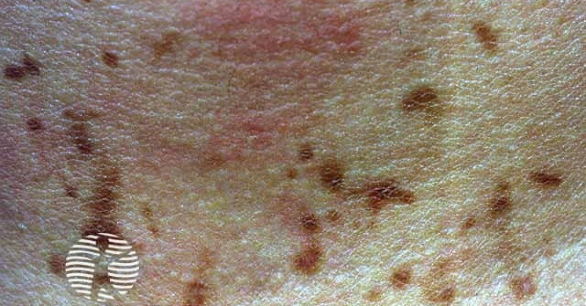 String trimmers dermatitis image