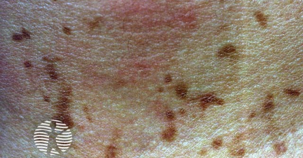 Pigmentary phytophotodermatitis image