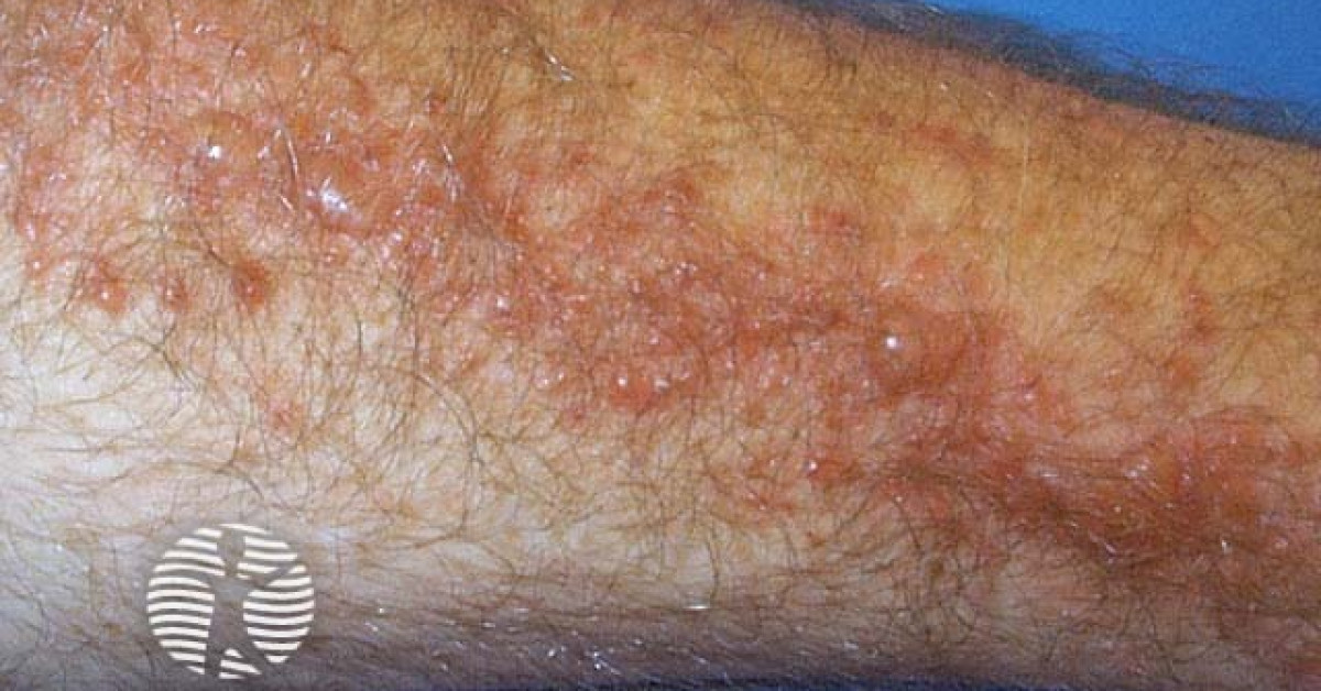 Plant dermatitis image