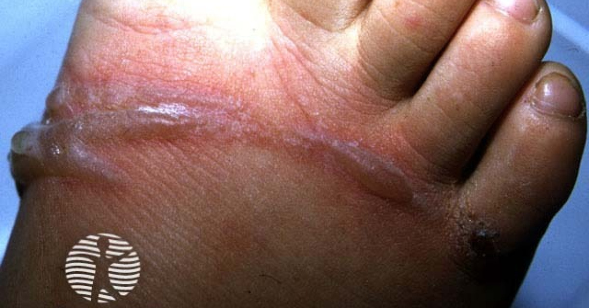 Plant dermatitis image