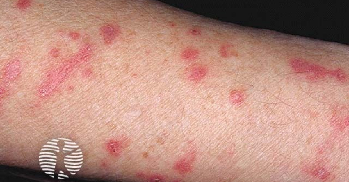 Pigmentary phytophotodermatitis image