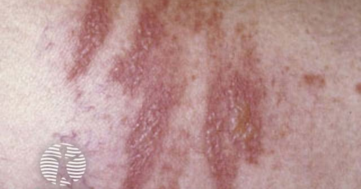 Pigmentary phytophotodermatitis image