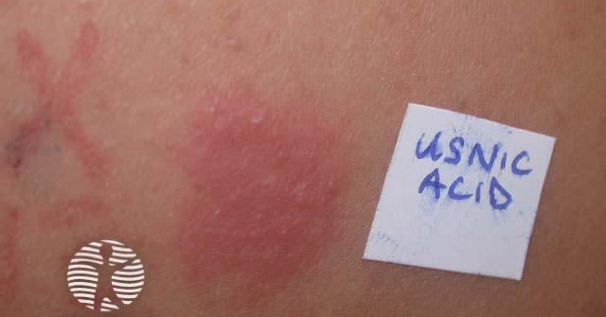 Patch test allergy to usnic acid image