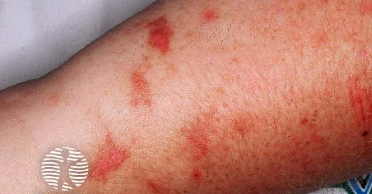 Acute phytophotodermatitis image