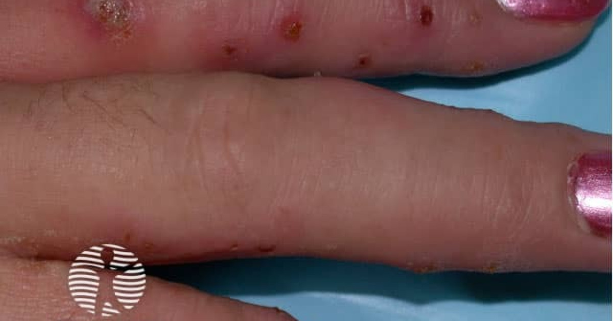 Complications of pompholyx image