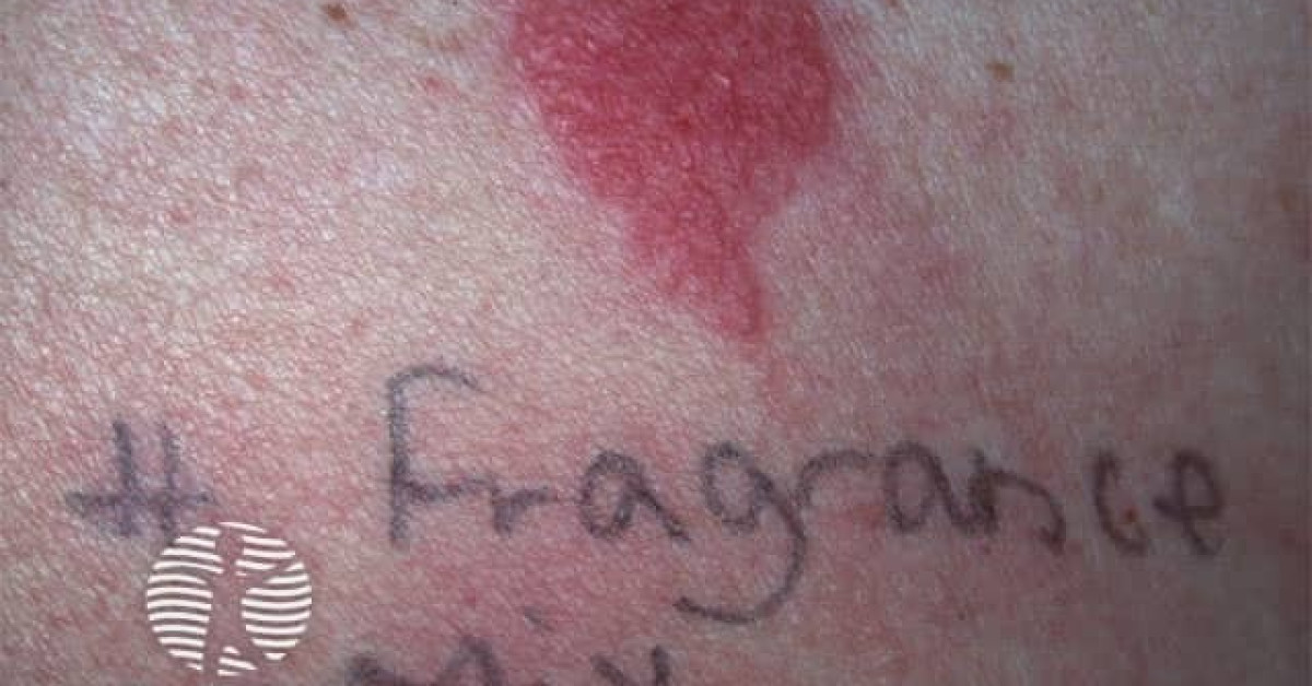 Patch Tests Image