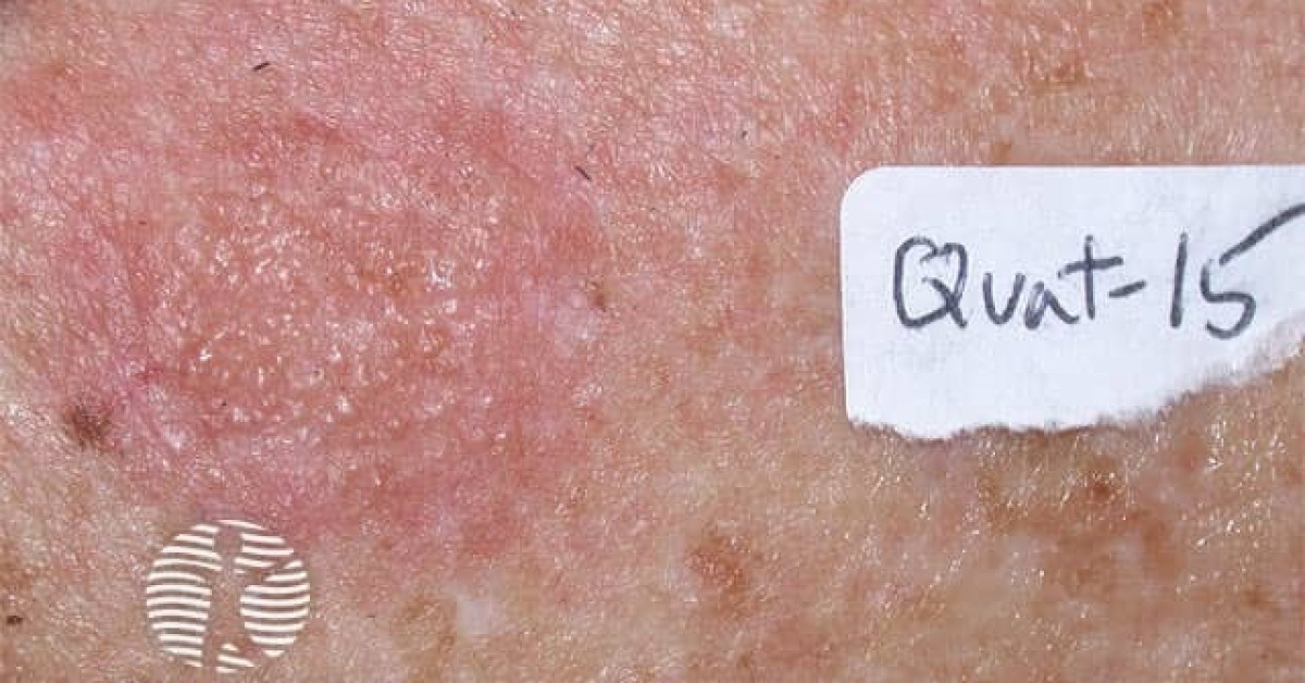 Positive patch tests image