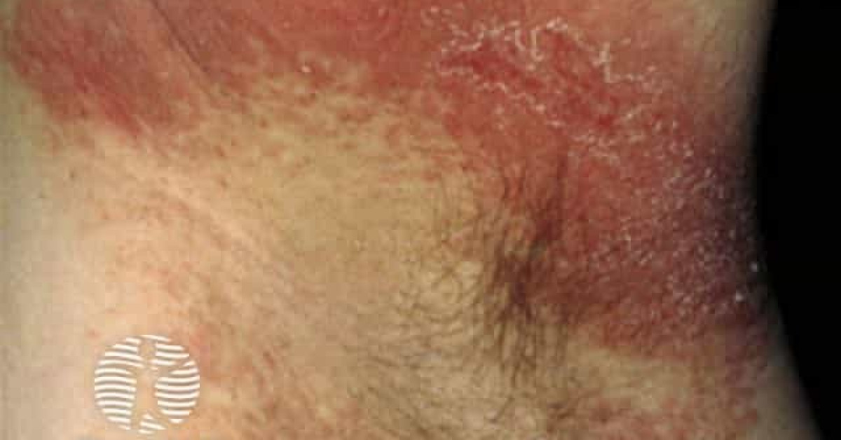 Intertrigo due to contact allergy to benzocaine image