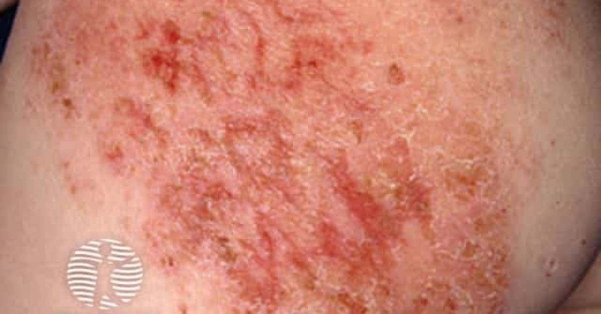 Atopic dermatitis image