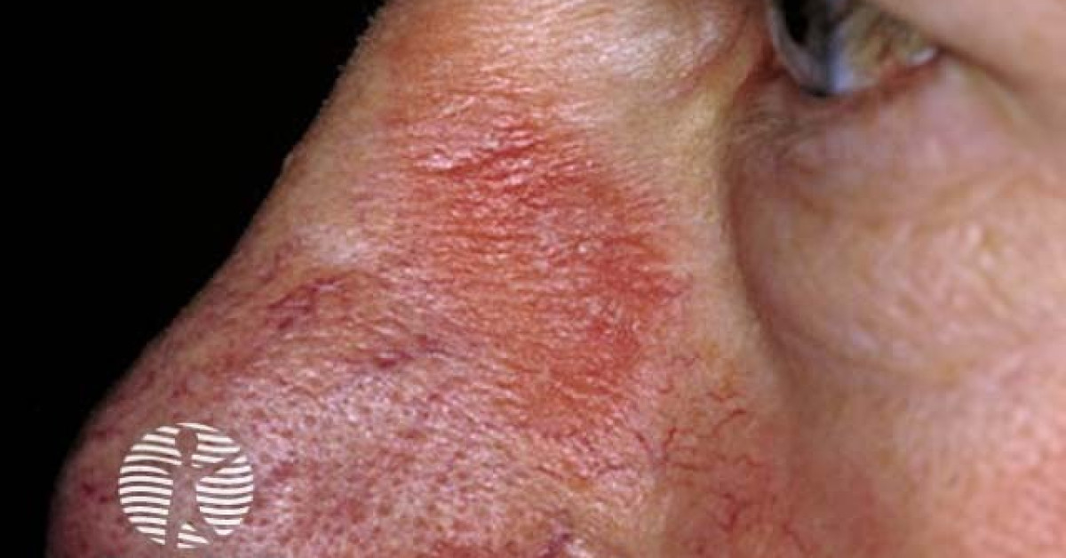 nickel allergy image