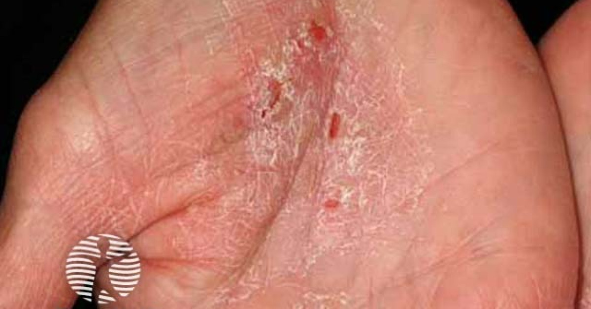 Chronic hand dermatitis image