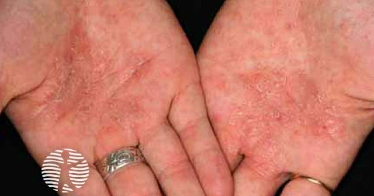 Chronic hand dermatitis image