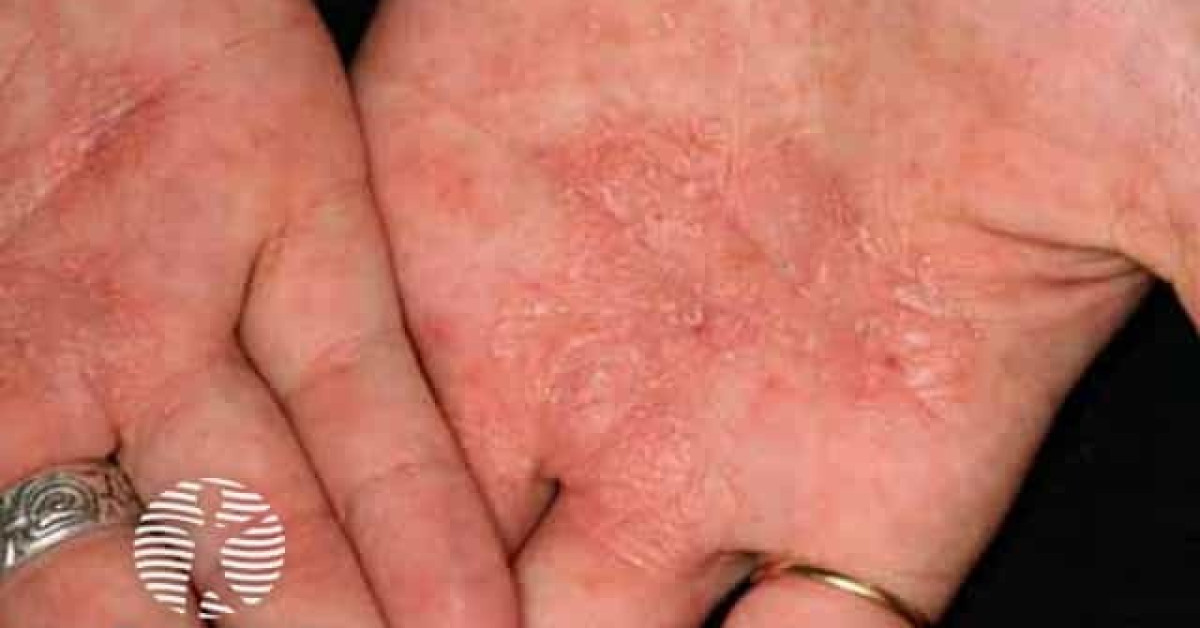 Chronic hand dermatitis image