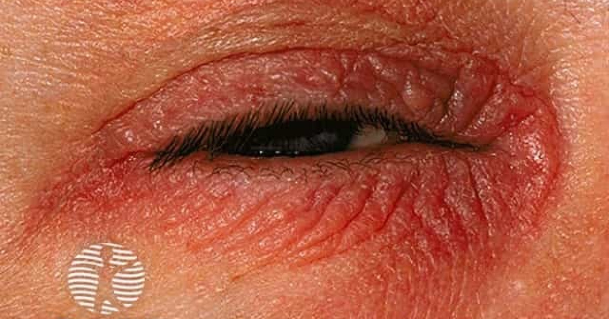 Eyelid contact dermatitis image