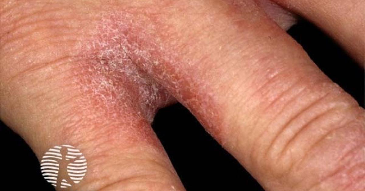 Irritant dermatitis image