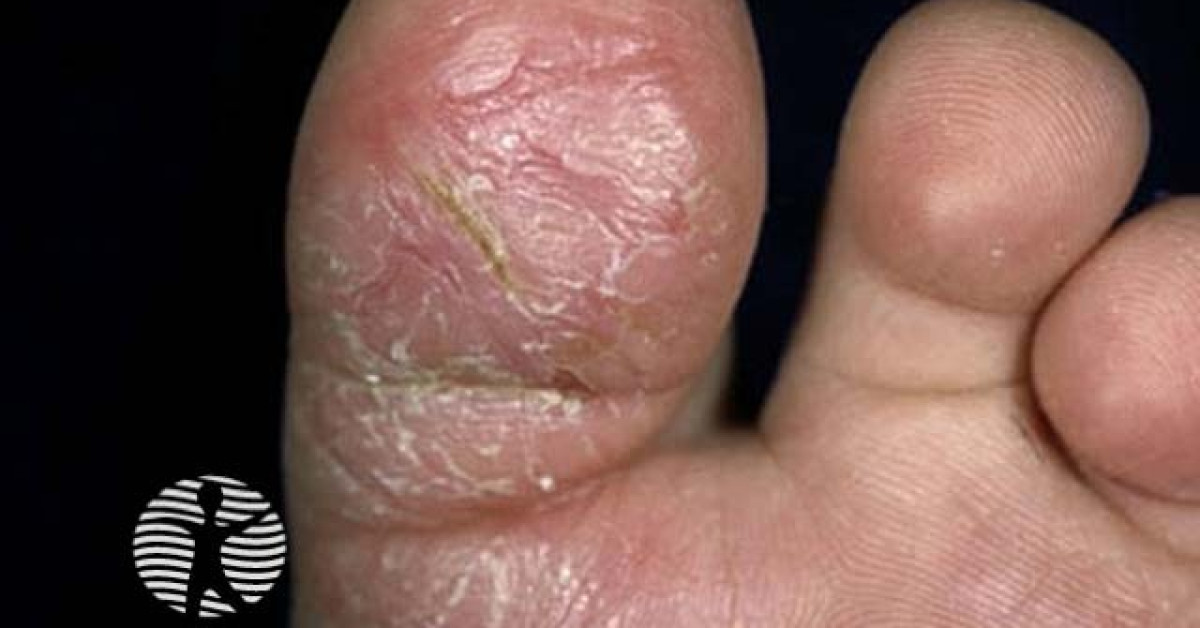 Juvenile plantar dermatosis image
