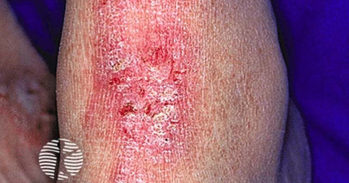 Lichen simplex image