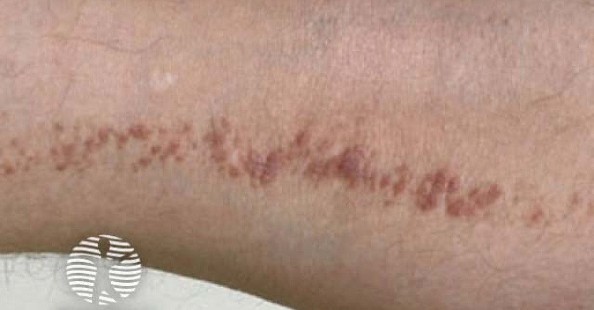 Lichen striatus image