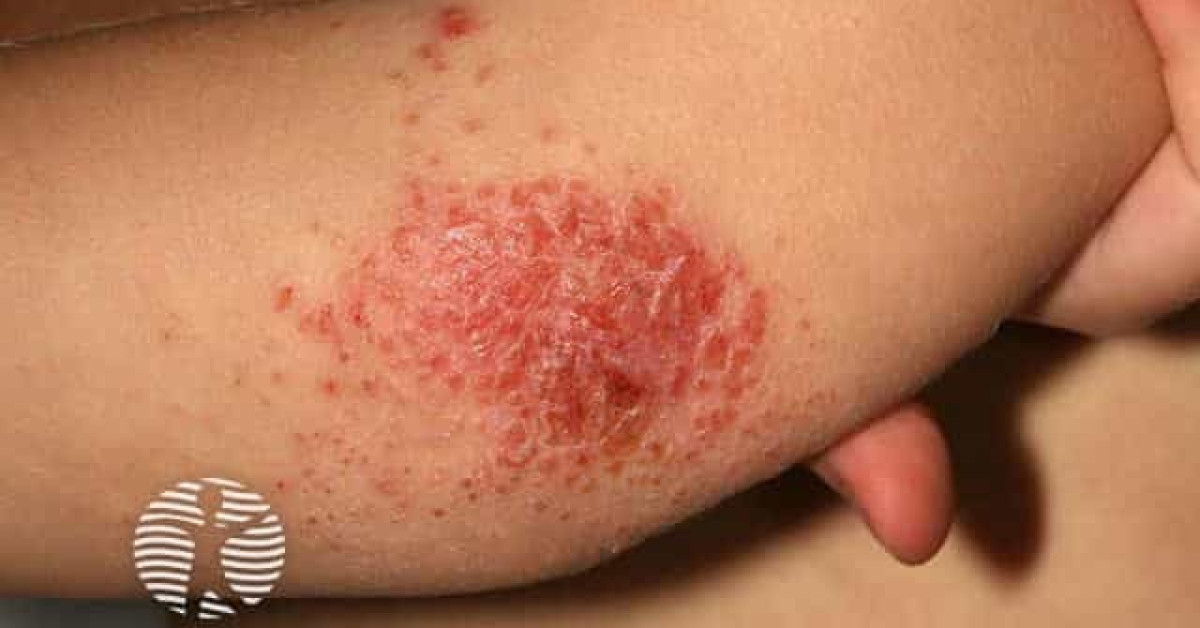 Nummular dermatitis discoid eczema image