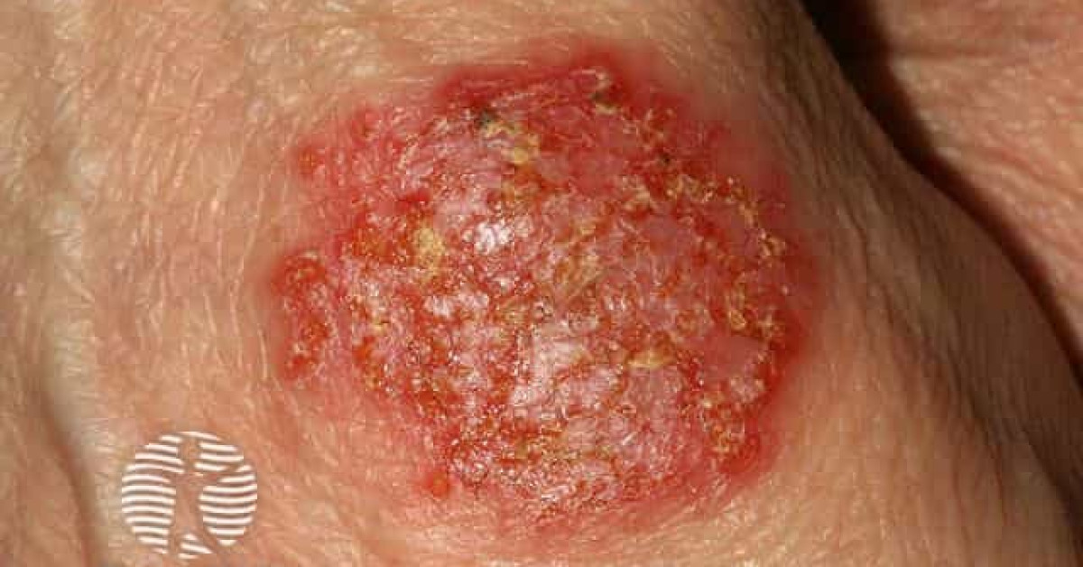 Nummular dermatitis discoid eczema image